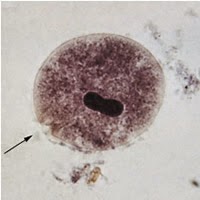 Psychology of Medicine: Balantidium coli