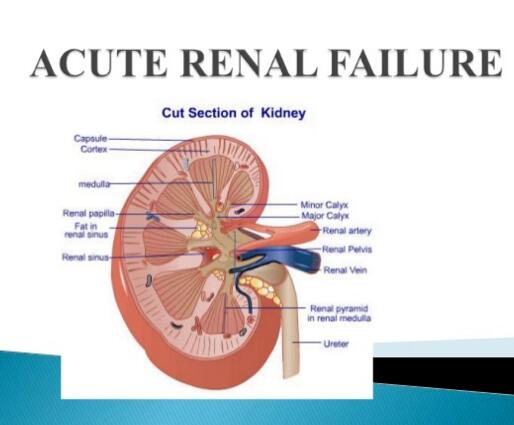 Treatment For Kidney Disease Do You Know Acute Renal Failure treatment-for-kidney-disease-do-you-know-acute-renal-failure
