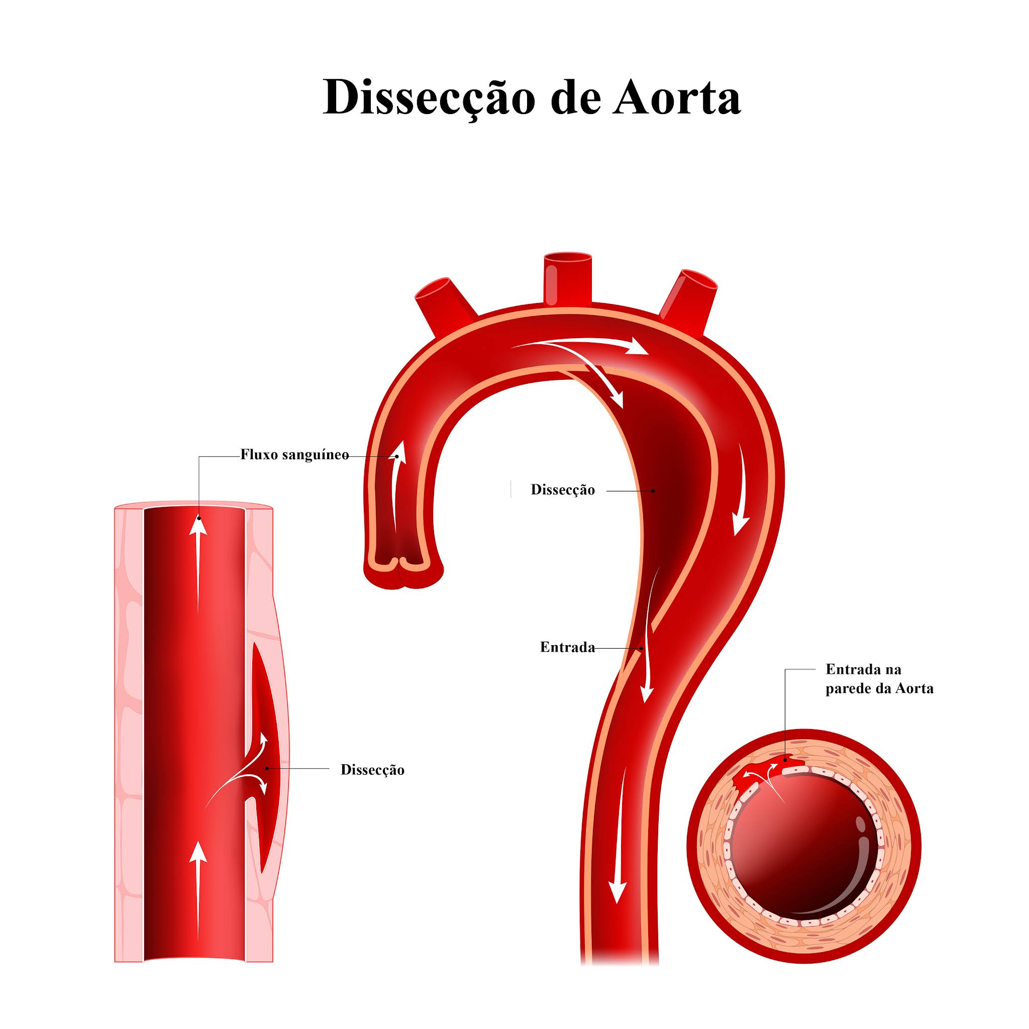 Dissecção de Aorta representa risco de vida e exige um diagnóstico ...
