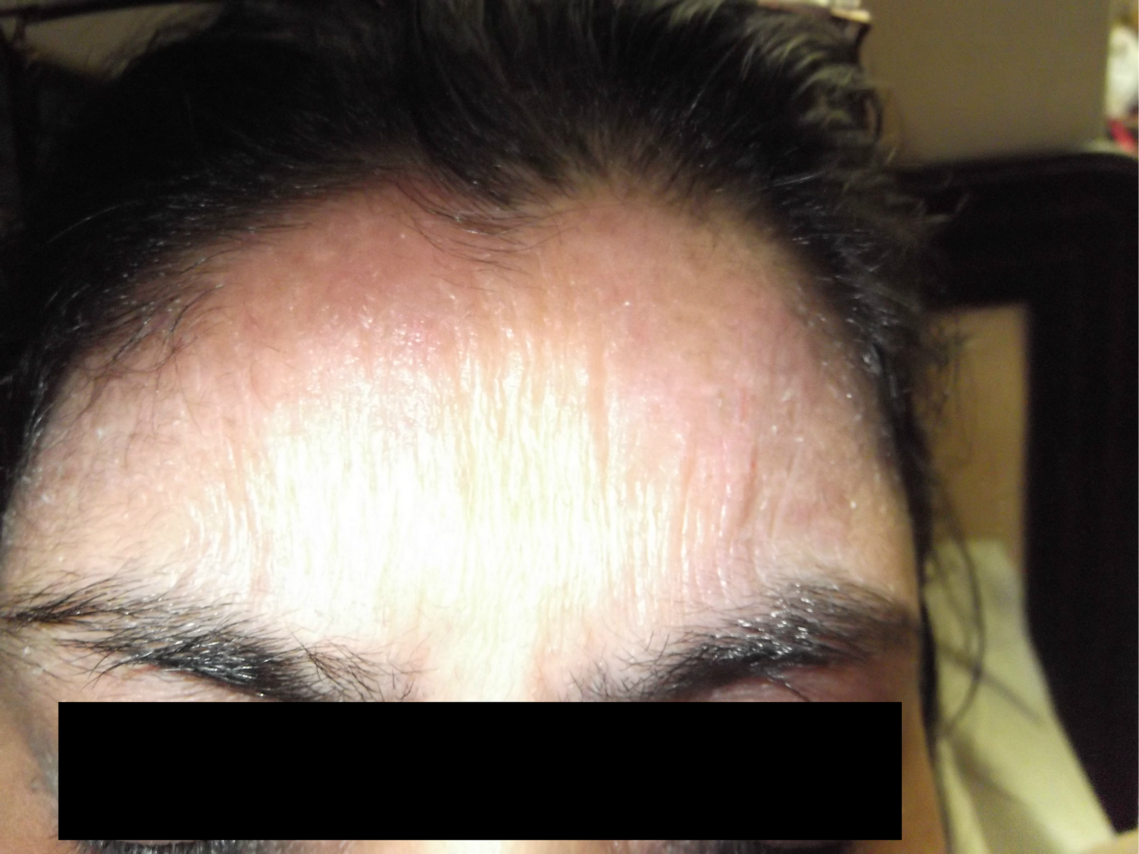 Eczema... The Constant Battle: 3rd Day Post Injection