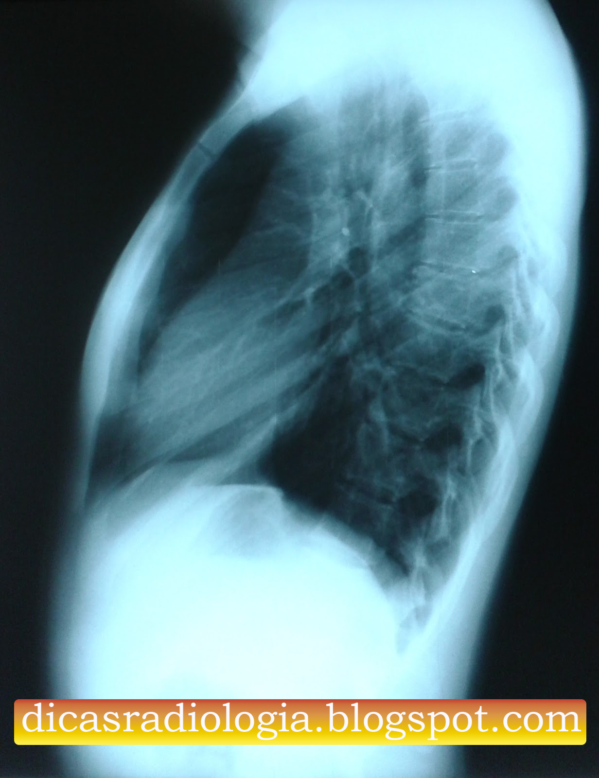 DICAS DE RADIOLOGIA - Tudo Sobre Radiologia: RAIO X DO TÓRAX - INCIDÊNCIA RADIOLÓGICA EM PERFIL