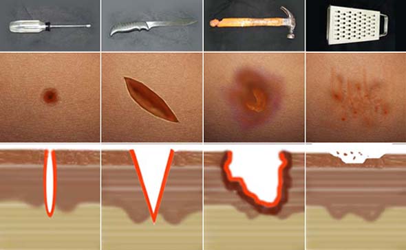 Urgencias y Emergencias Médicas : Heridas