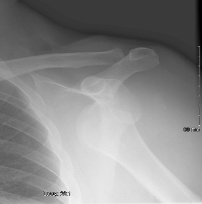 Shoulder and Elbow Surgery: Shoulder dislocation resulting in massive ...