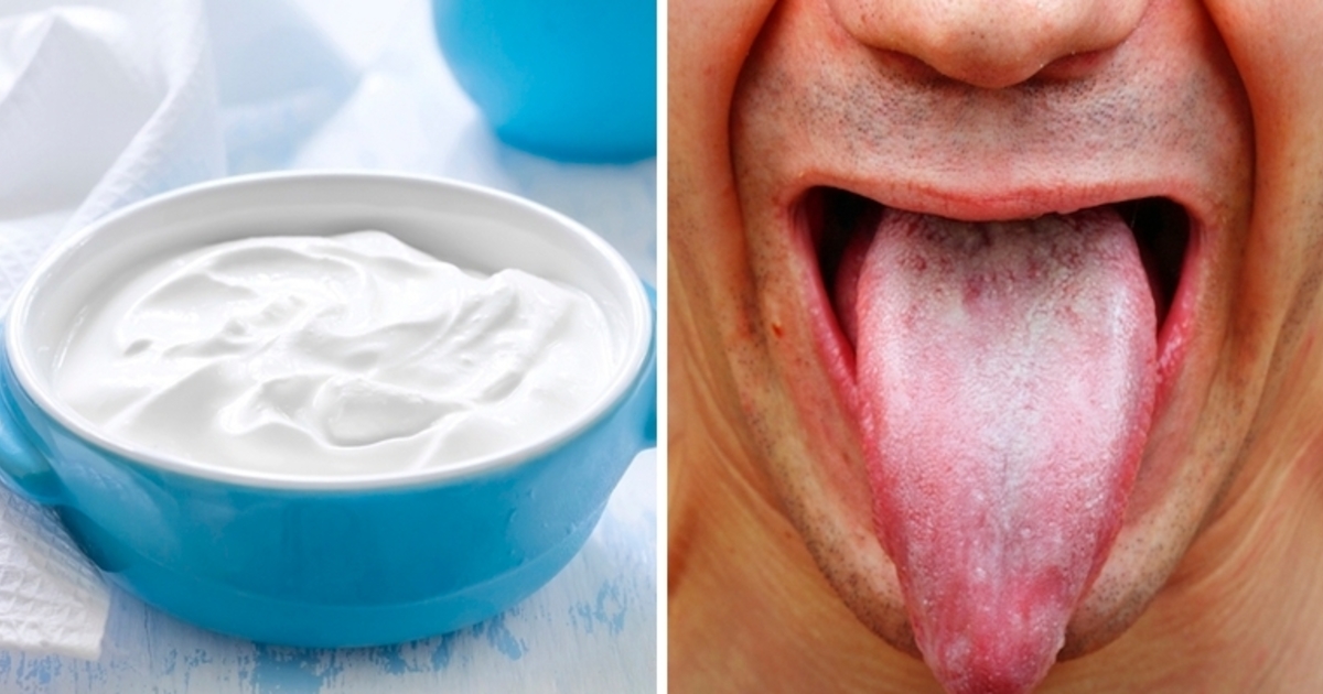 Notas Exclusivas Para Mujer: ﻿Conoce como tratar los hongos de la boca.