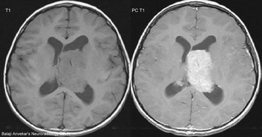 Neuroradiology Cases: Choroid plexus papilloma MRI
