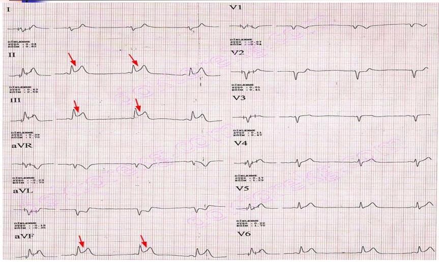 ACİL TANI VE TEDAVİ: AKUT MIYOKARD INFARKTUS ( MI )