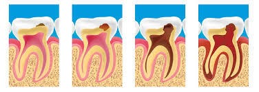 Mengenal lebih dekat karies gigi | Fitri Amalia