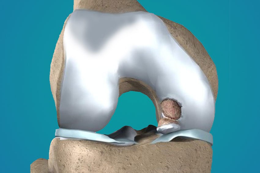 Fisioterapia Alfonso Calvo: Osteocondritis disecante de rodilla