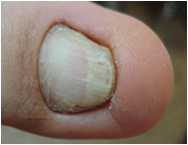 Dermatología: MODIFICACIONES EN LA UNIDAD UNGULAR