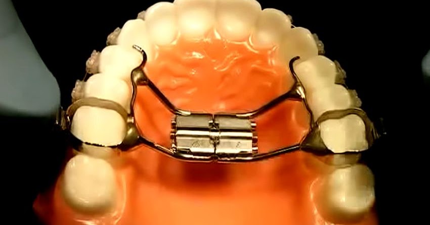 JAW EXPANDER: How to Turn - Steve Yang - Odonto-Tv
