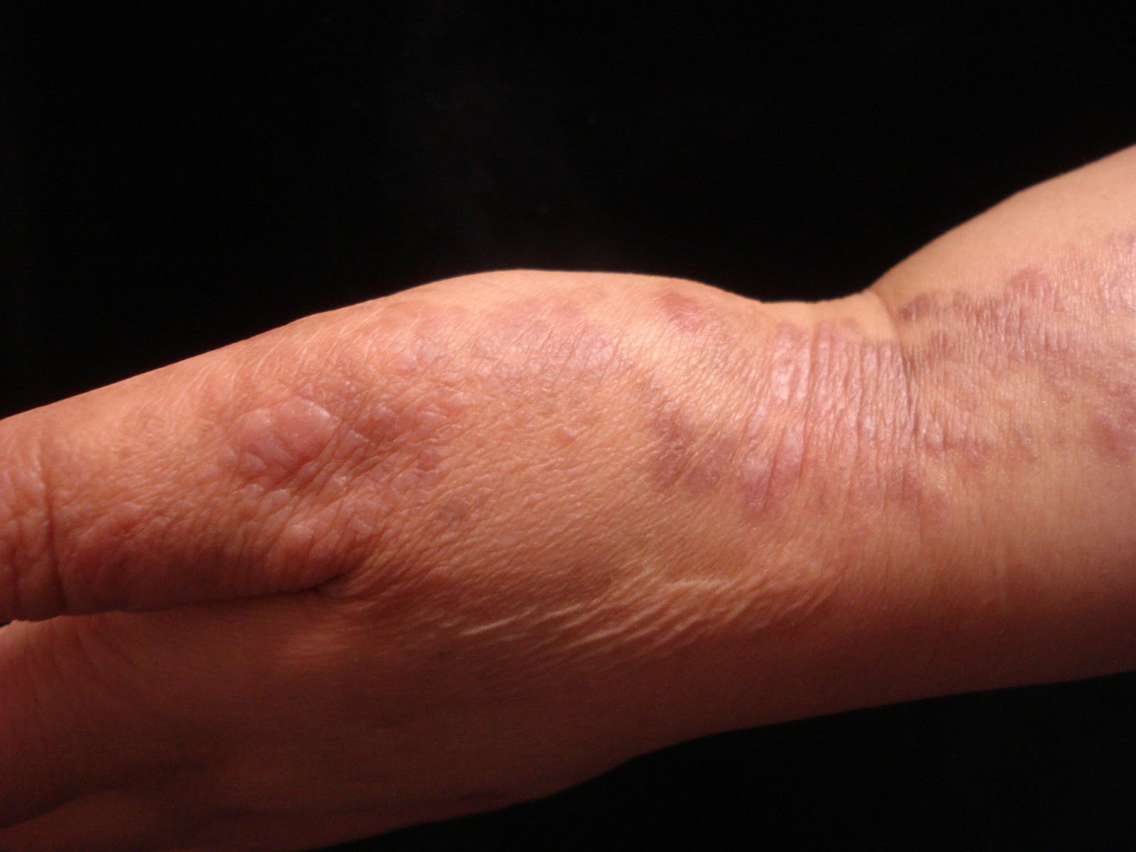 VIRTUAL GRAND ROUNDS IN DERMATOLOGY 2.0: Unusual Linear Dermatosis