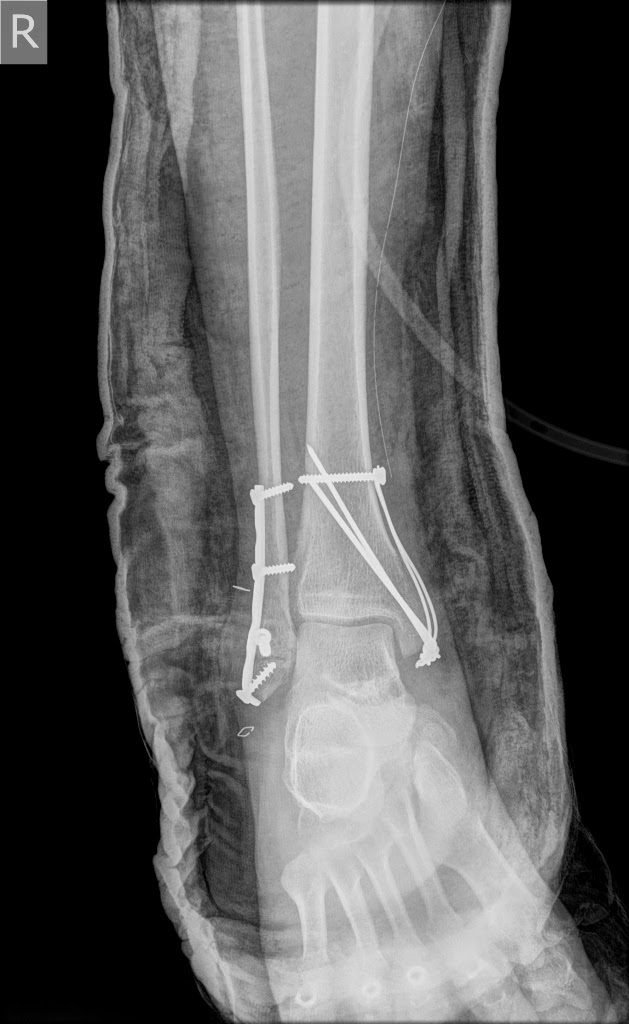 My Broken Right Ankle and Me.: The Surgery and Pain of my broken ankle