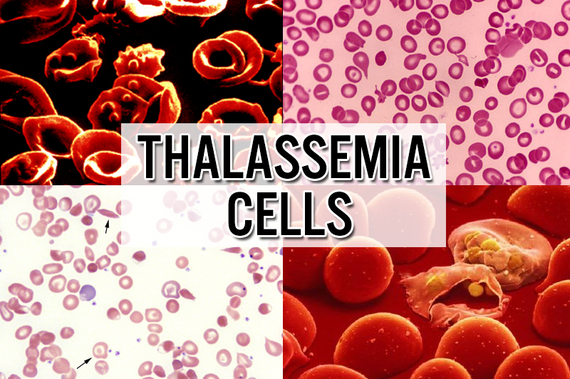 Be Healthy, Be Beauty: Atasi Kesan Talasemia Tanpa Ubat