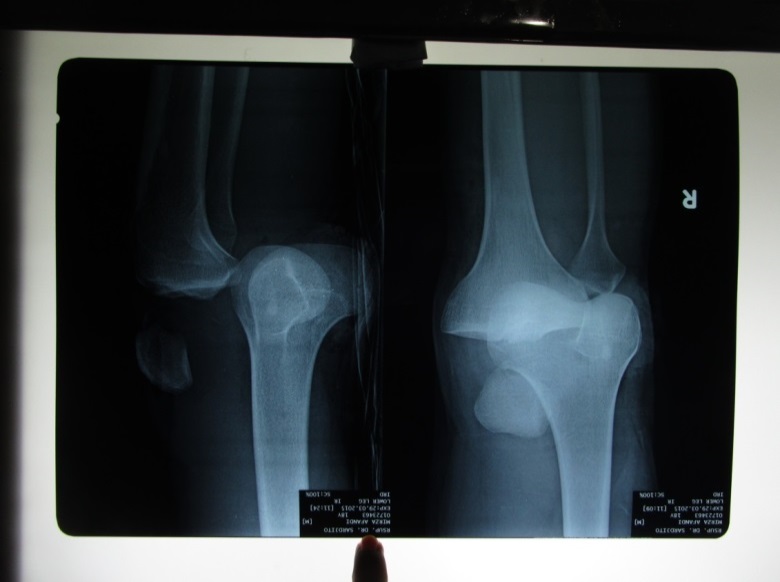 Orthopaedi Knowledges: DISLOCATION OF THE KNEE JOINT