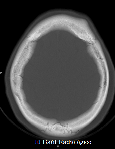 El Baúl Radiológico: OSTEOMAS CRANEALES. (Cranial Osteomas. CT Findings ...