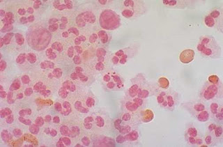 EM Girl: Diagnosis of meningitis