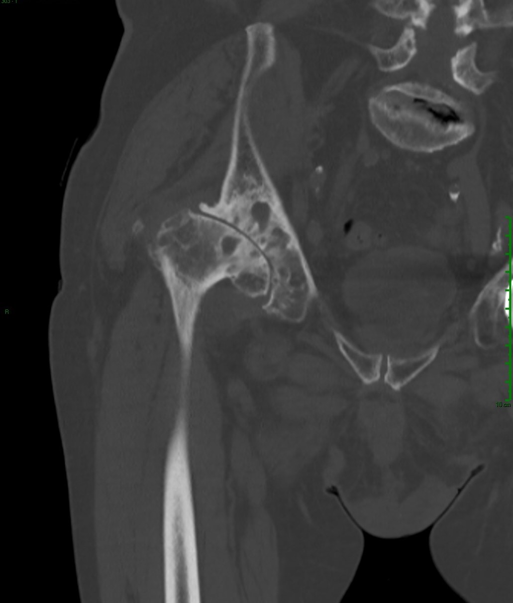Developmental dysplasia of the hip (DDH): sequel in adult.