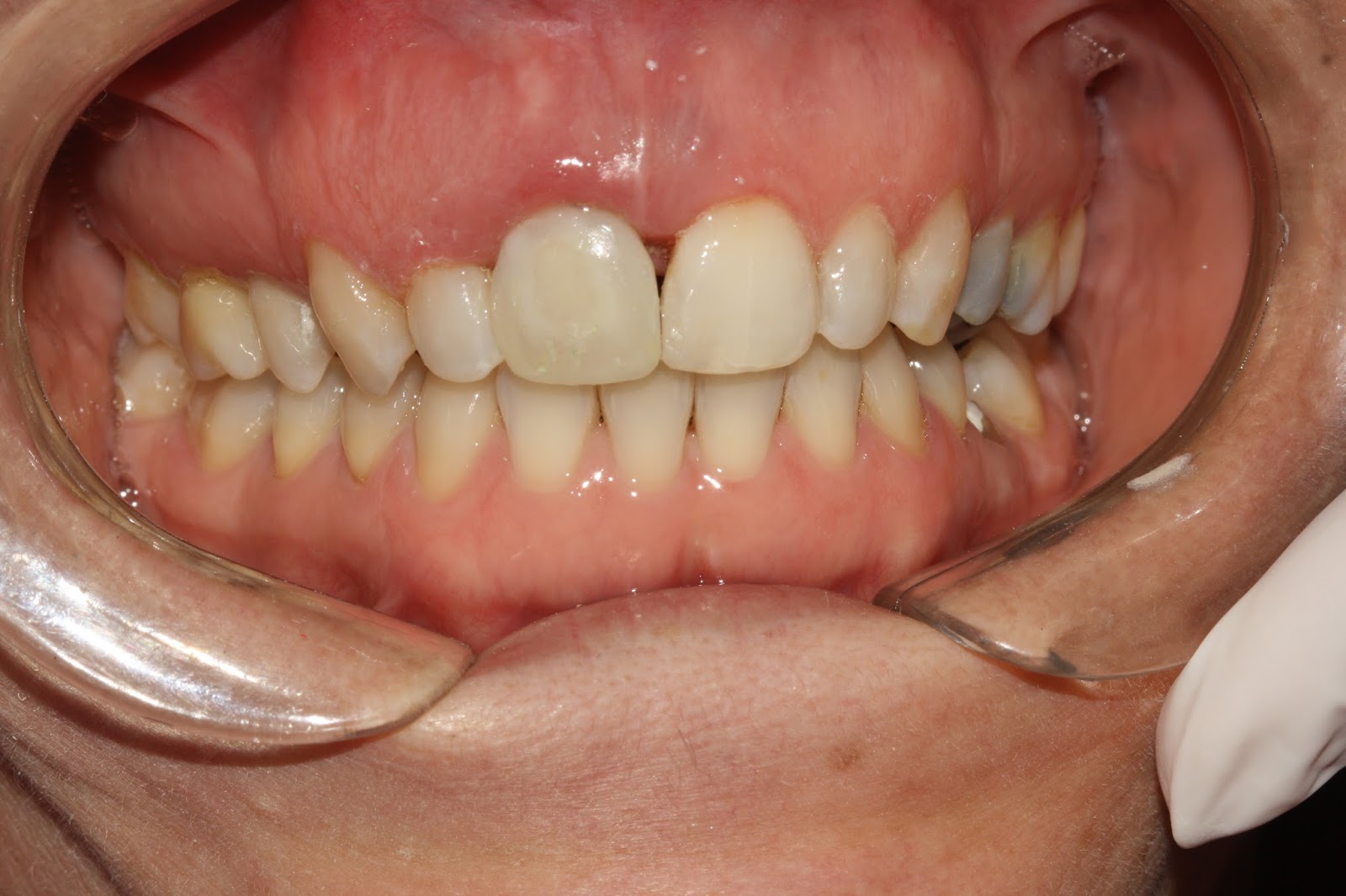 Estetica en Anterior en Prostodoncia FIja Moderna : Ponticos Ovoides