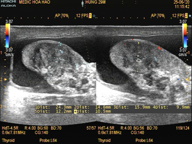 VIETNAMESE MEDIC ULTRASOUND: CASE 589: TB OF TESTIS, Dr PHAN THANH HẢI ...