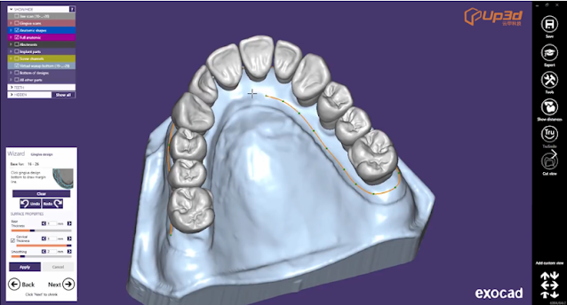 Dental CAD/CAM system: Implant Bridge design by exocad