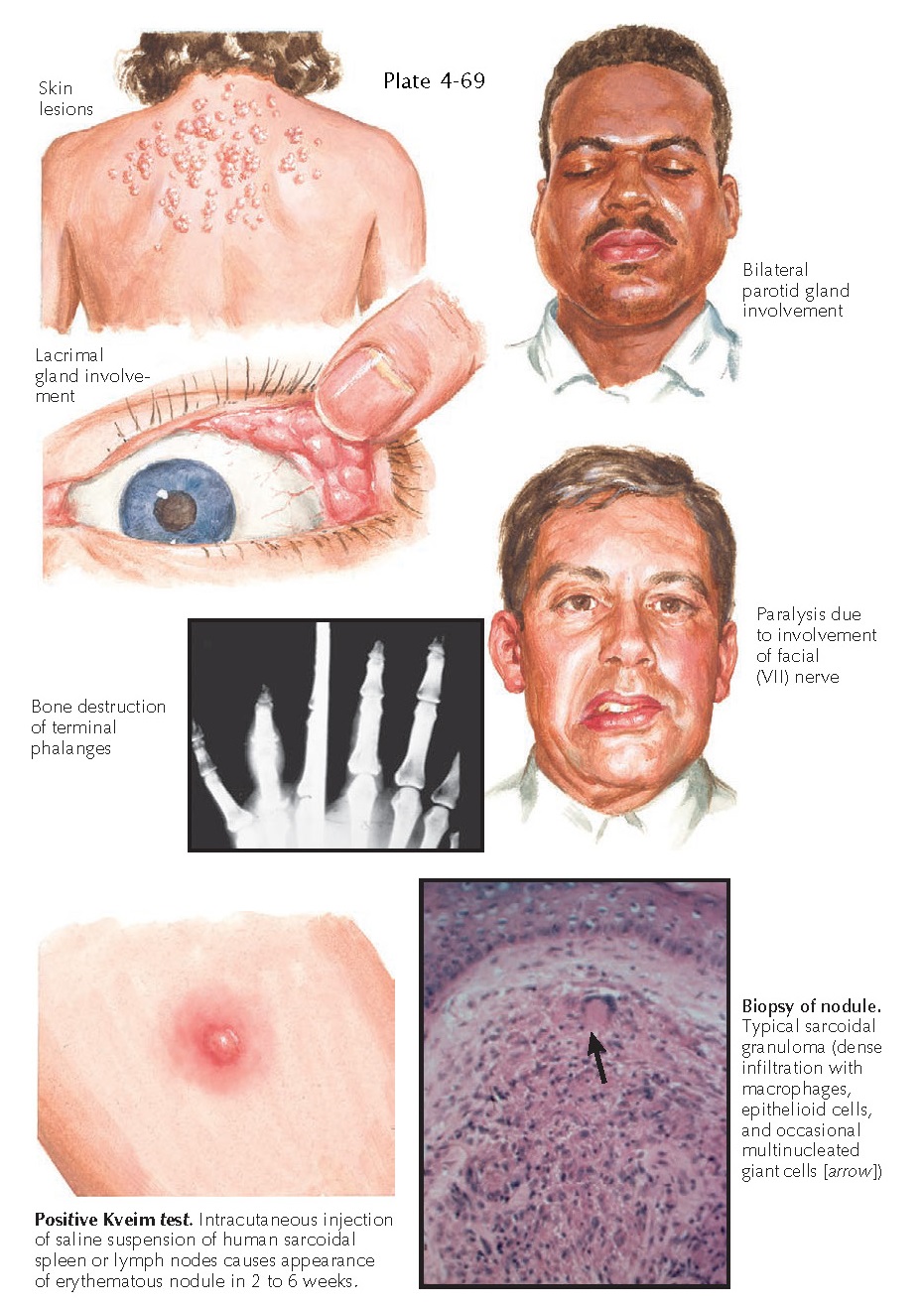 SARCOID - pediagenosis