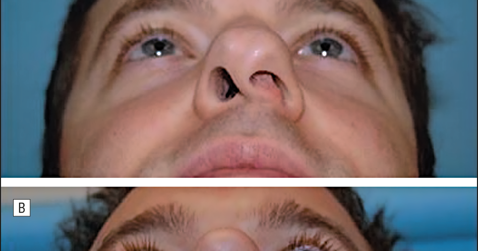 WiKi HEALTH CARE: When the nose bones are curved