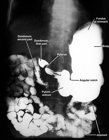 My Radiology World: Barium meal x-ray examination