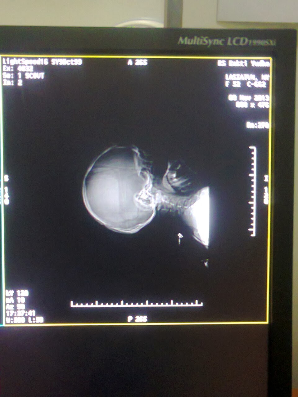 SiMpLe LoVe 'n LiVe: CT Scan (Computed Tomography Scanner)