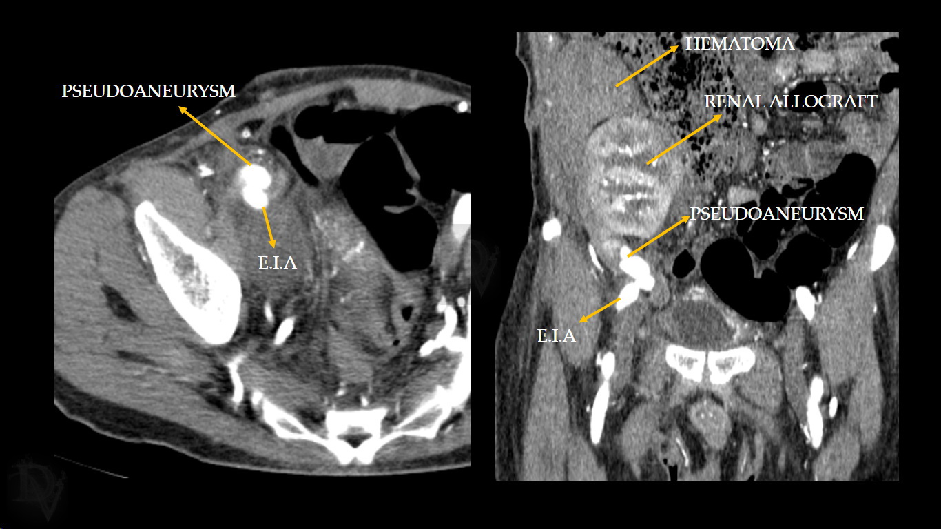 Ultimate Radiology : Large external iliac artery pseudoaneurysm ...