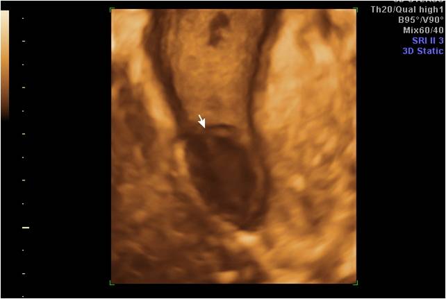 Gall Bladder Wall Cyst [ Possibly Submucous Cyst ]: An Ultrasound ...
