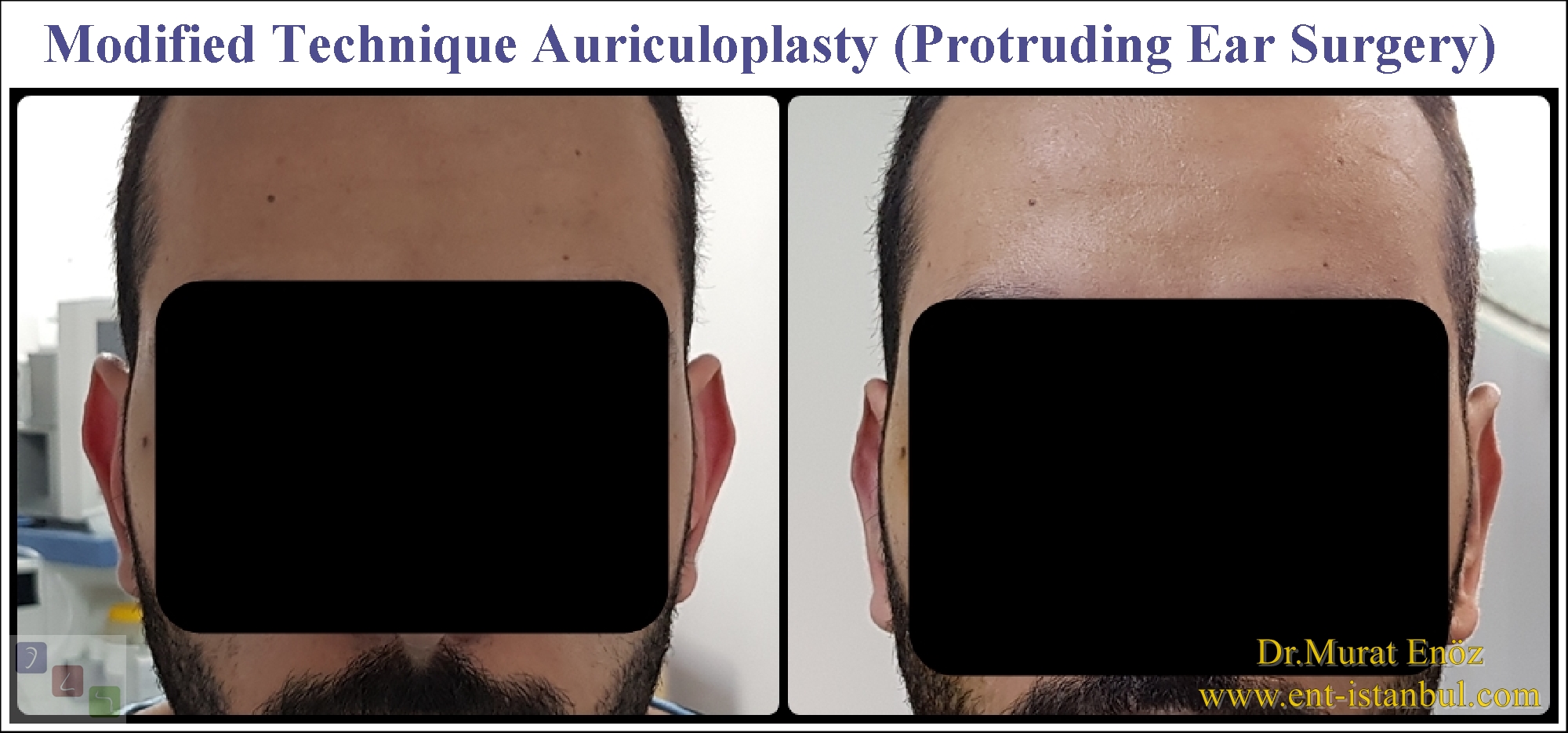 We Performed Again Modified Technique Auriculoplasty (Protruding Ear ...