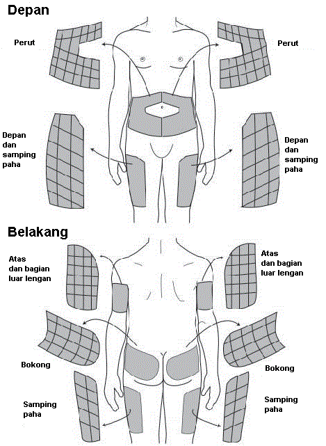 Cara Injeksi Insulin Dan Tempatnya - Pasien Sehat