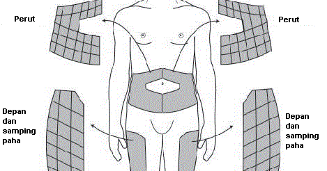 Cara Injeksi Insulin Dan Tempatnya - Pasien Sehat