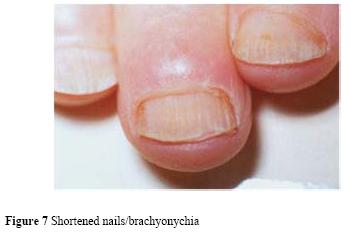 Nail Diseases: Brachyonychia