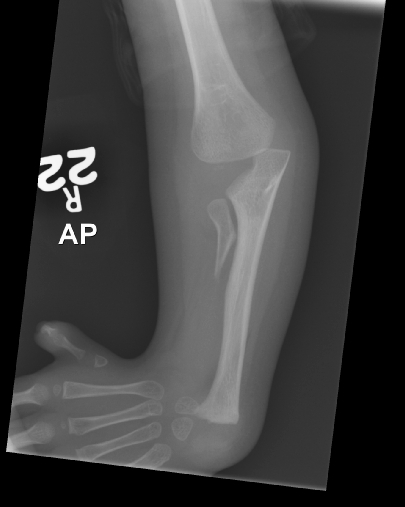 Severe Radial Deficiency- No slowing this kid down! | Congenital Hand ...