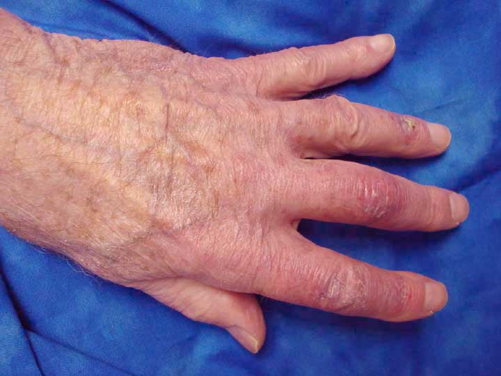 VIRTUAL GRAND ROUNDS IN DERMATOLOGY 2.0: Dermatomyositis?