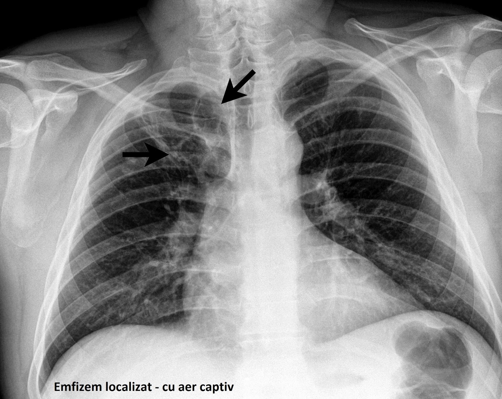 Medicine Conspectus: Sindromul clinic din emfizemul pulmonar. Sindromul ...