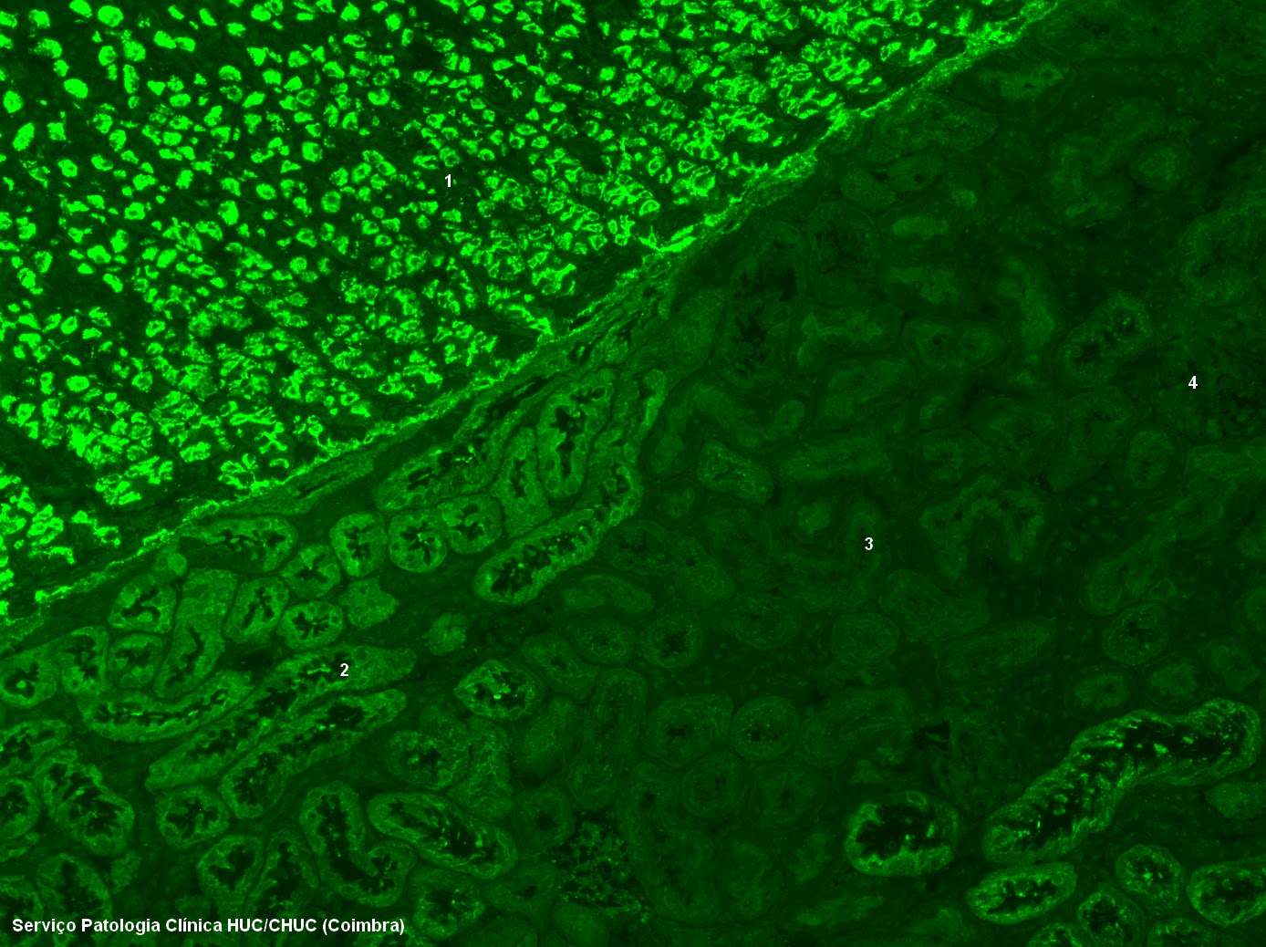 Anticorpos anti - LKM1