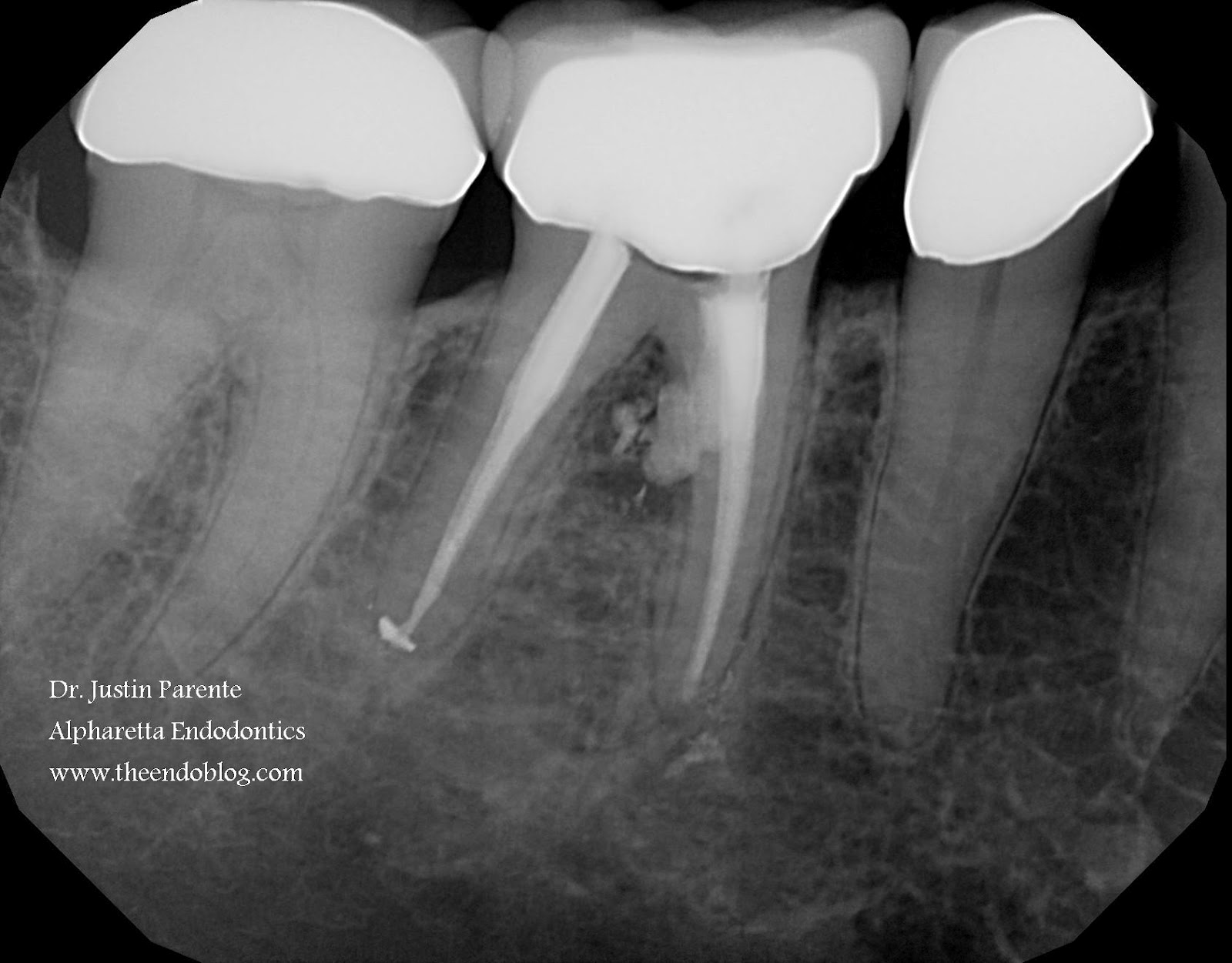 Perforation Repair Endodontics at Kevin House blog