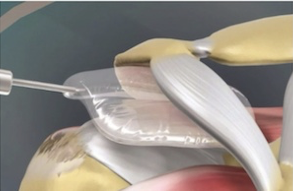 Shoulder Arthritis / Rotator Cuff Tears / Shoulder Pain : The ...