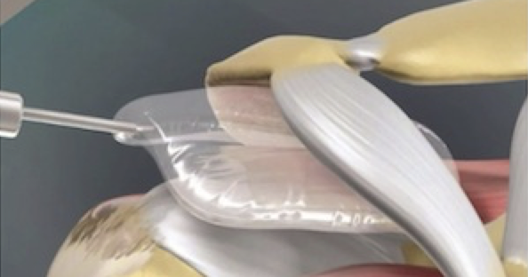 Shoulder Arthritis / Rotator Cuff Tears / Shoulder Pain : The ...