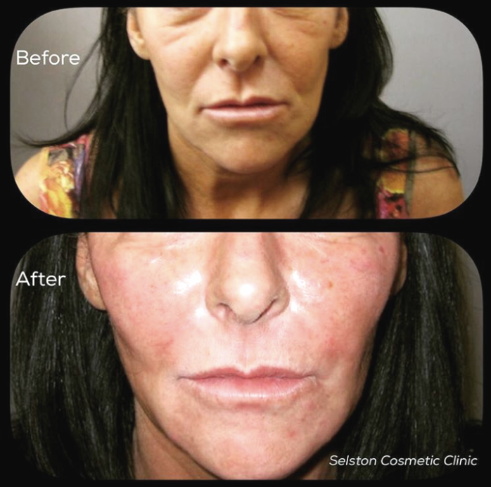 Selston Cosmetic Clinic: Liquid Facelift Treatment Using Botox & Dermal ...