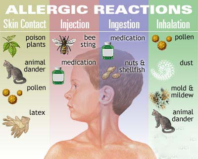 What is allergy | Signs Symptoms of Allergic Reaction - Medical School ...