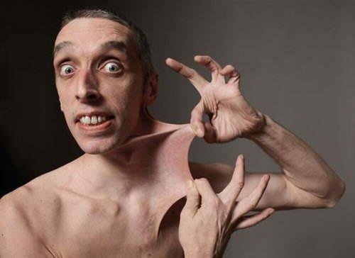 Factsramblog: The most stretchable skin - Garry Turner