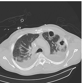 Abses Paru-Paru (Lung abscess)