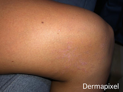 Dermapixel: Las anémonas también pican