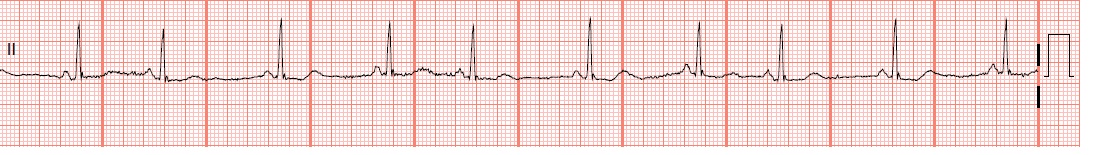 EKG Rhythm Strip Quiz 28