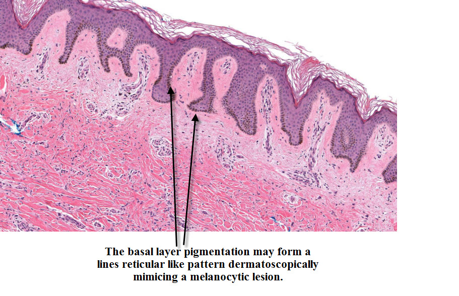 Dermpath Made Simple - Neoplastic: Dermatofibroma