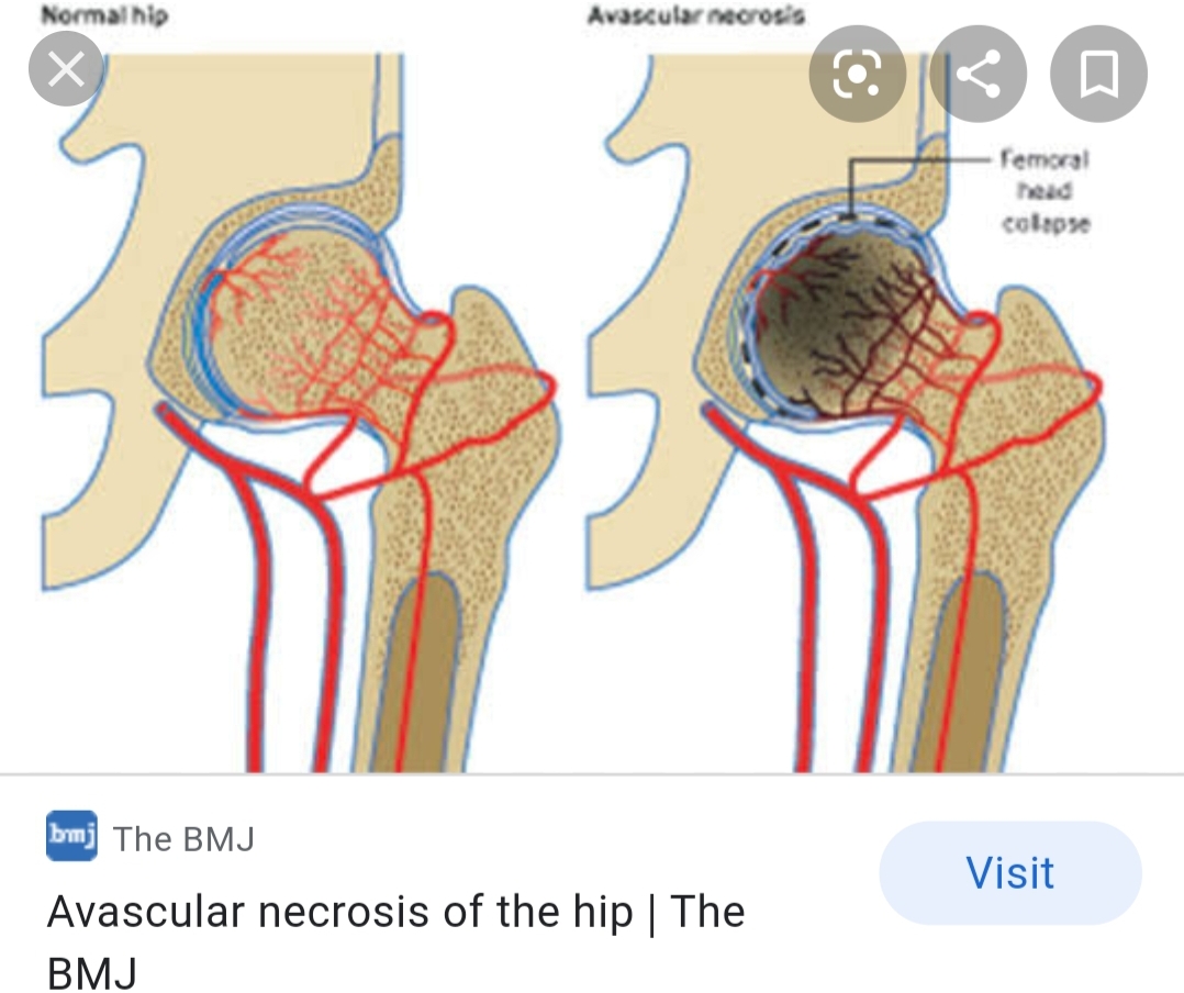 Avascular Necrosis of Bone in sickle cell Snemia
