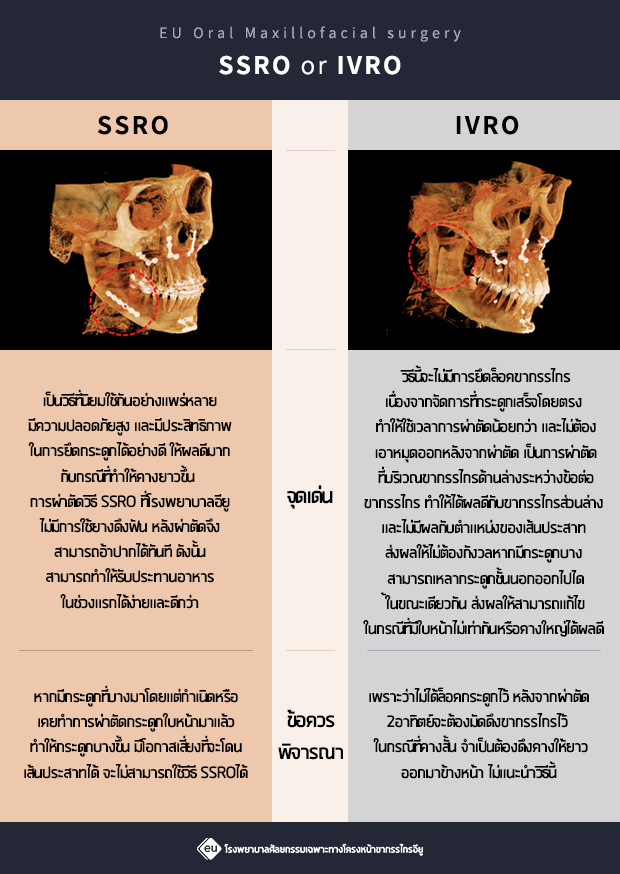 โรงพยาบาลอียู EU Surgery: วิธีผ่าตัด SSRO และ IVRO